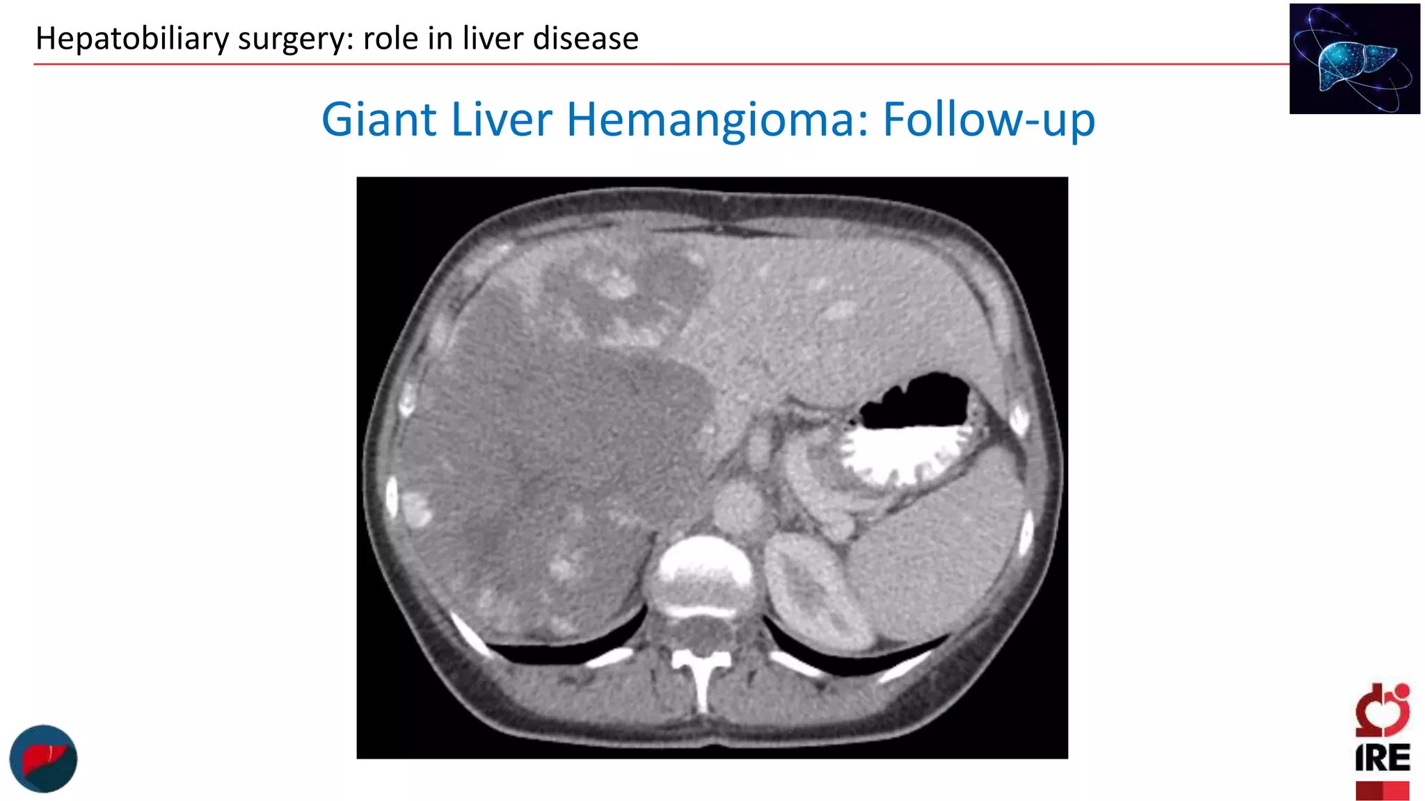 Hepatobiliary surgery - role in liver diseases.pptx