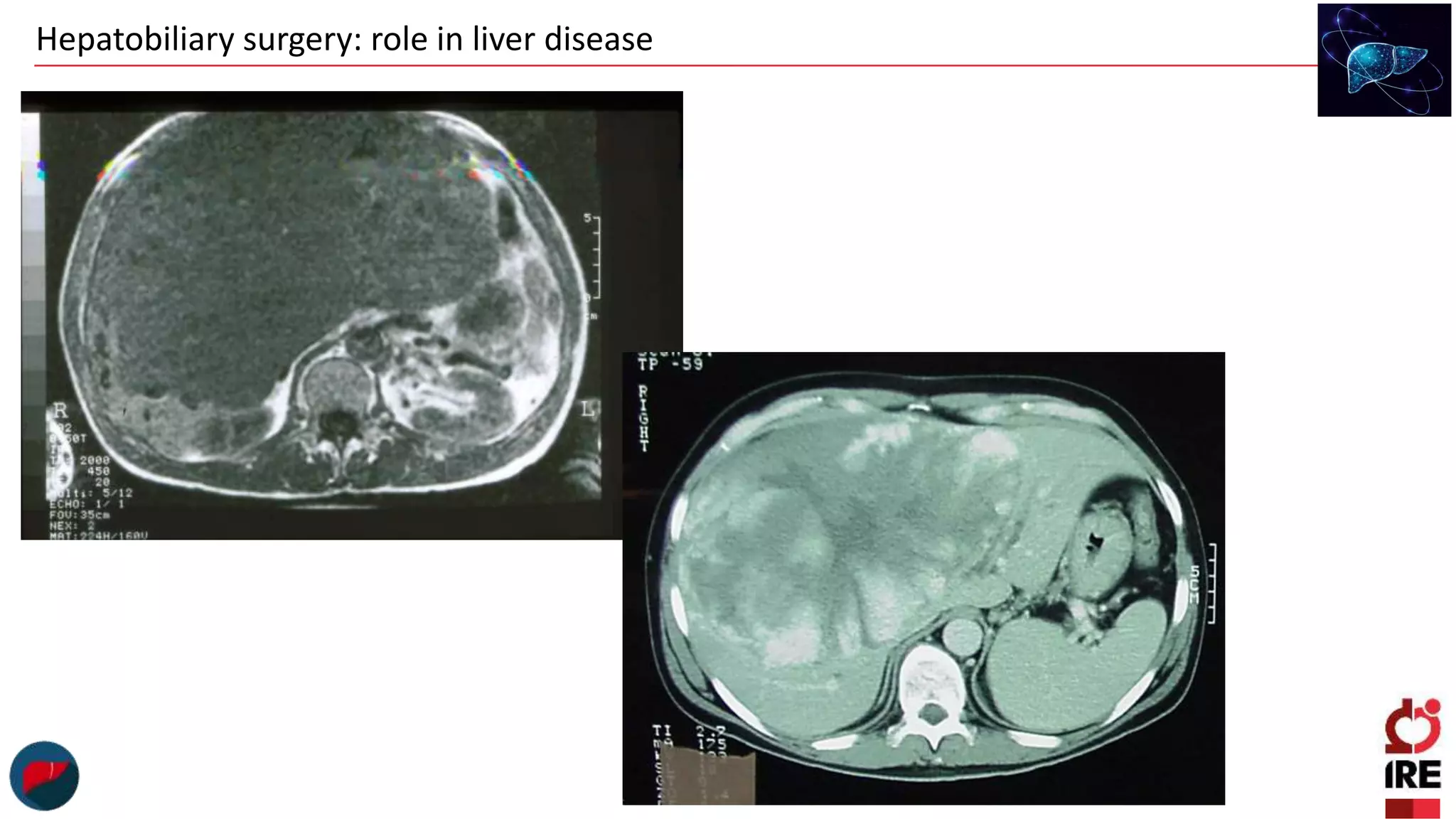 Hepatobiliary surgery - role in liver diseases.pptx