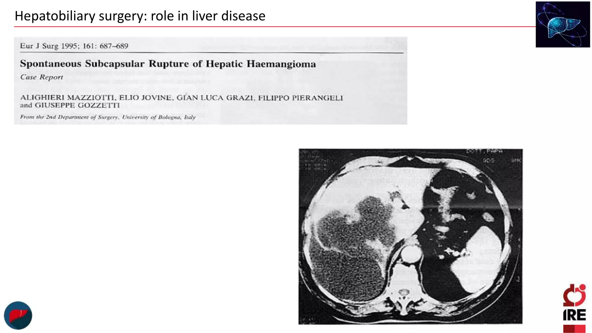 Hepatobiliary surgery - role in liver diseases.pptx