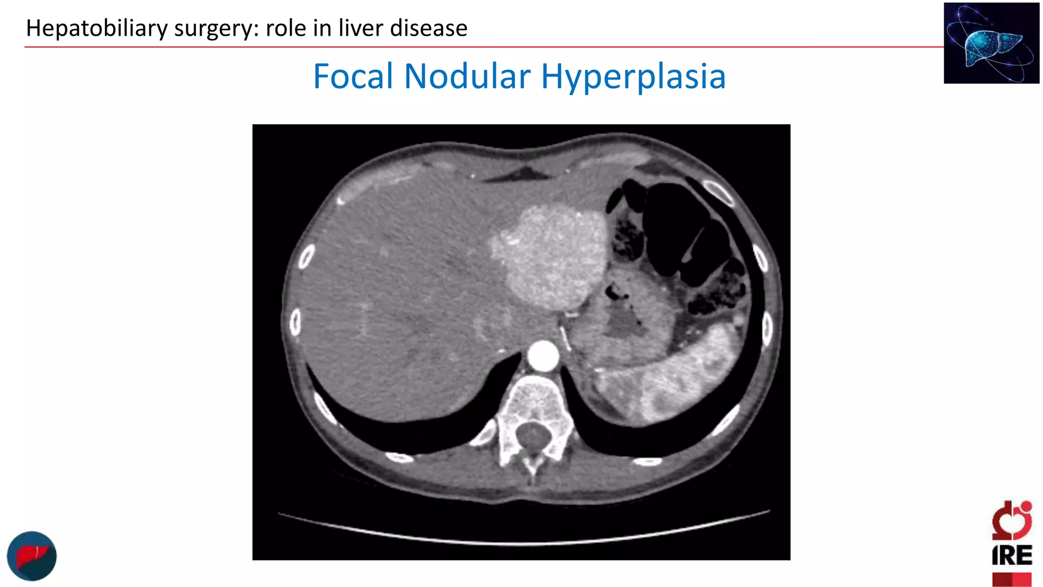Hepatobiliary surgery - role in liver diseases.pptx