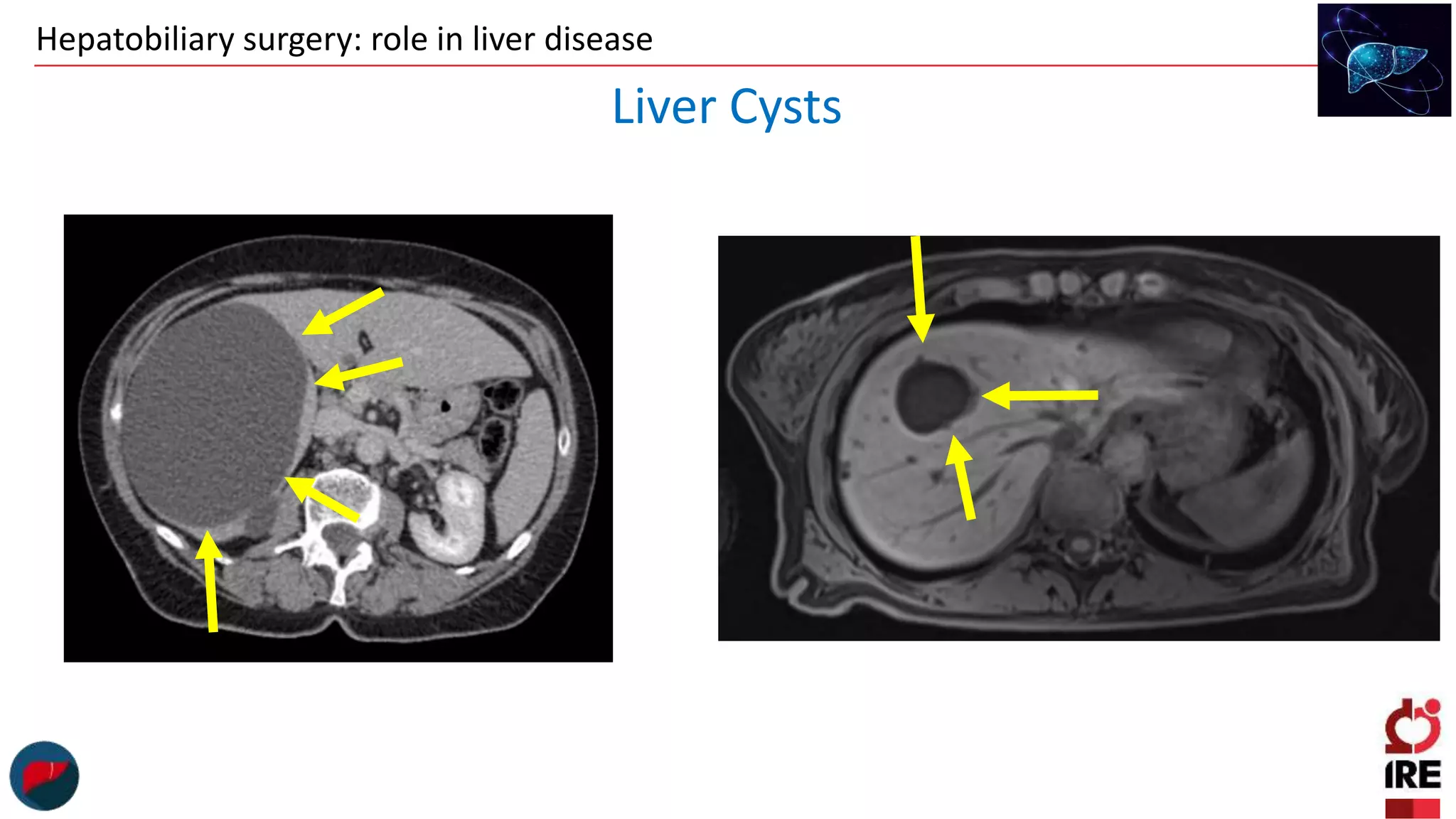 Hepatobiliary surgery - role in liver diseases.pptx