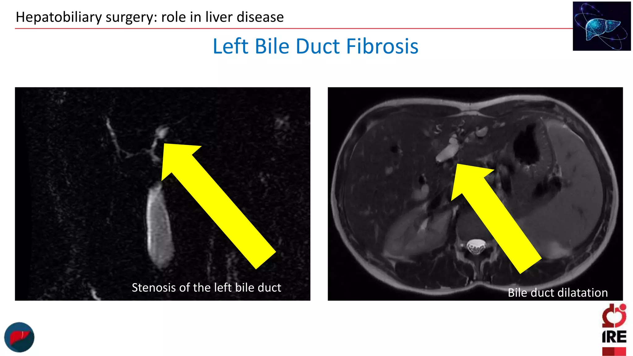 Hepatobiliary surgery - role in liver diseases.pptx
