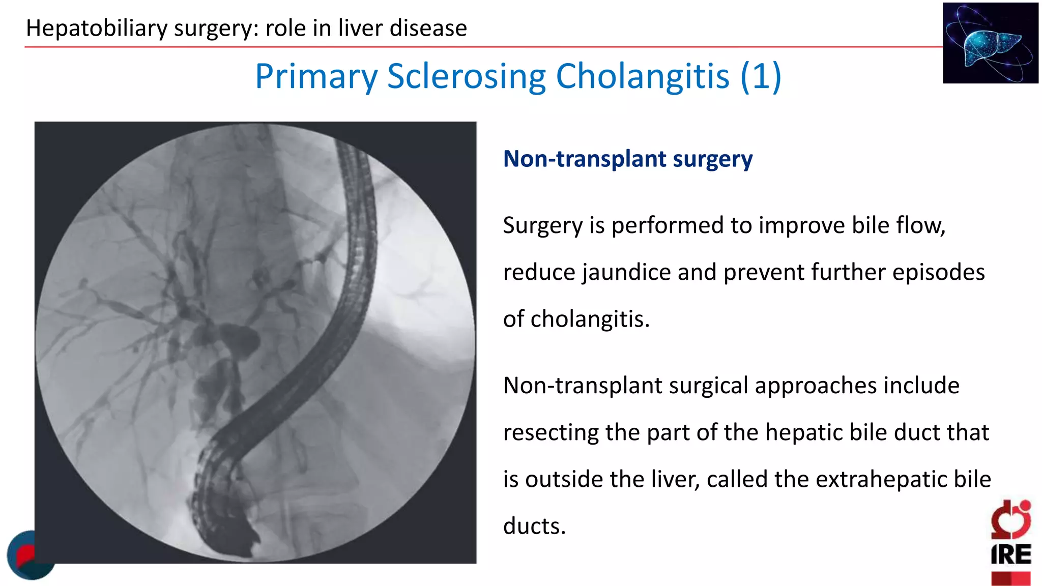 Hepatobiliary surgery - role in liver diseases.pptx