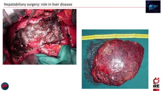 Hepatobiliary surgery - role in liver diseases.pptx
