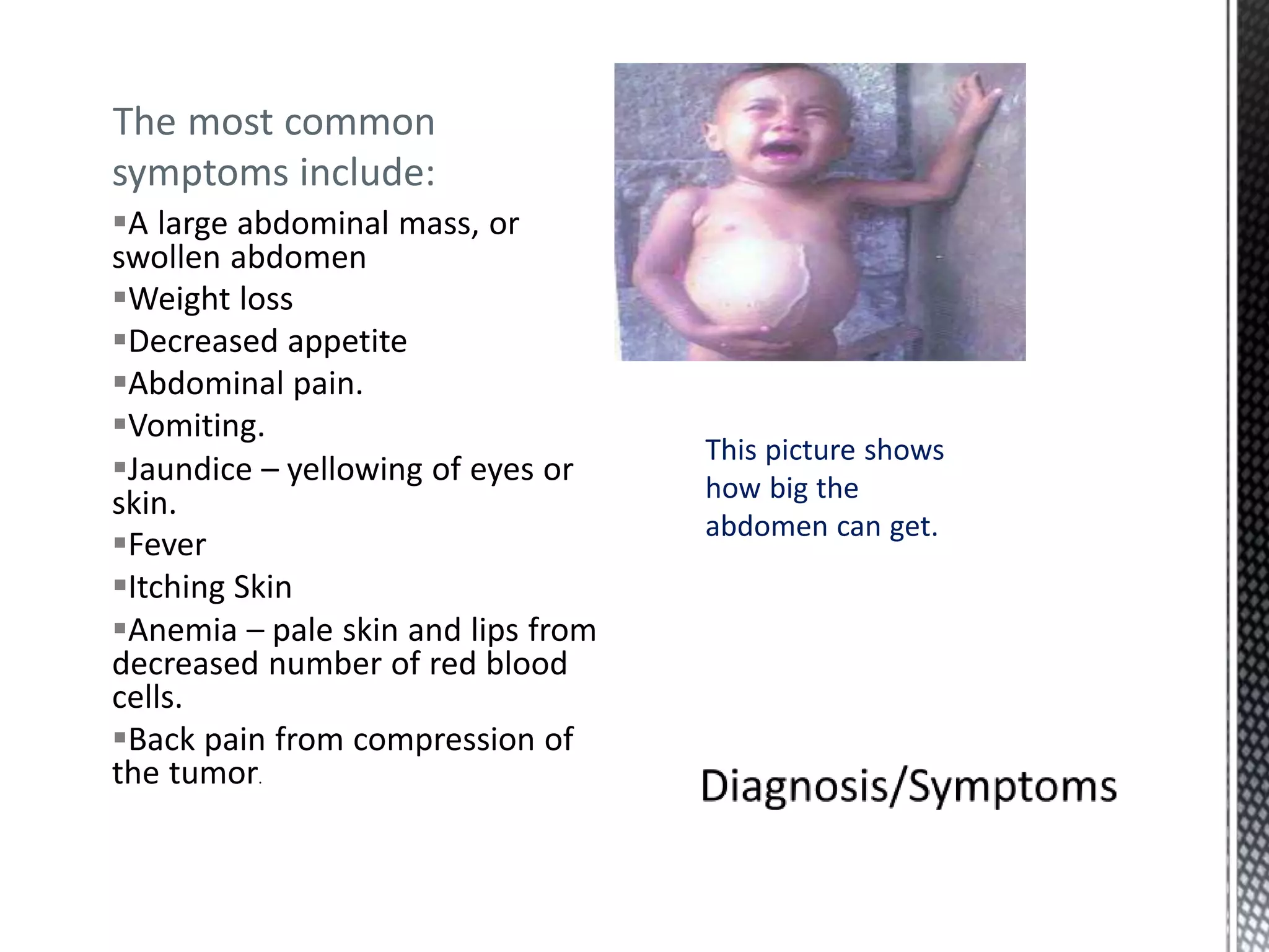 hepatoblastoma.ppt