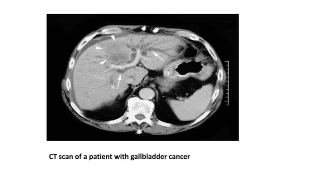 HEPATOCELLULAR AND GALL BLADDER CARCINOMA.pptx