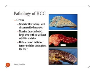 Hepatocellular Carcinoma Gross