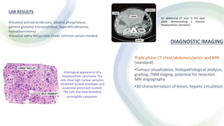 Hepatocellular carcinoma | PPTX