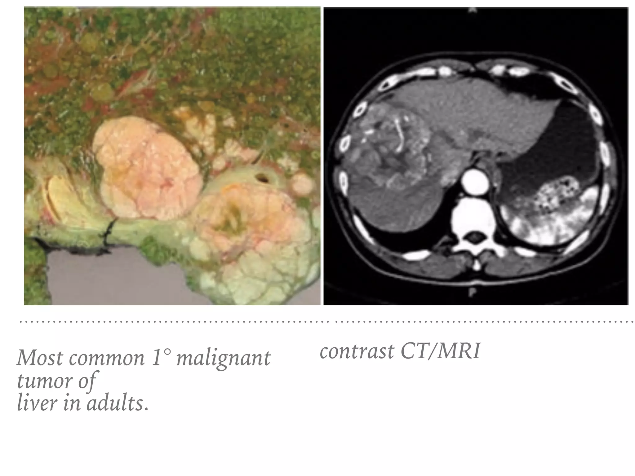 Hepatocellular carcinoma | PPT