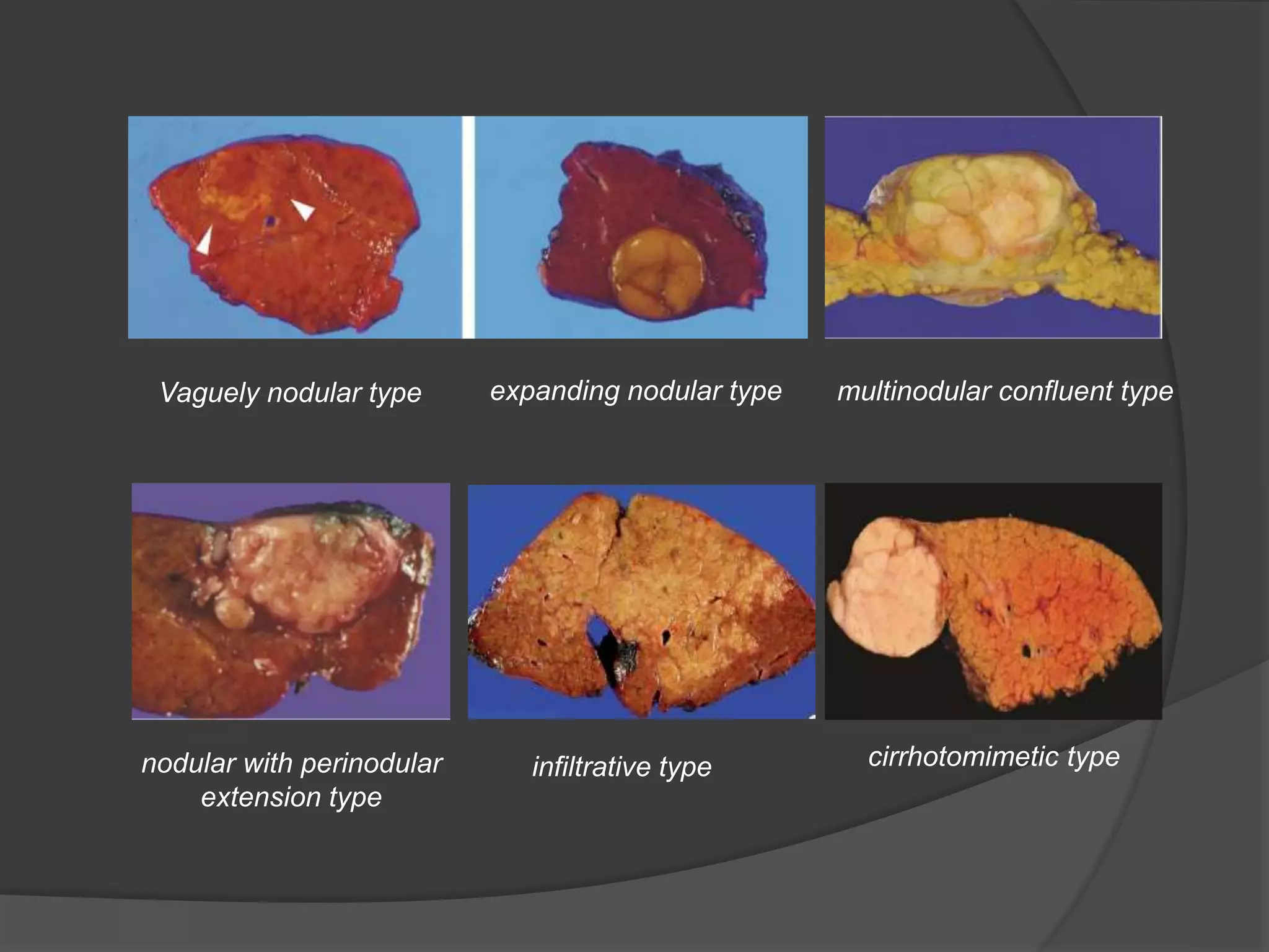 Hepatocellular carcinoma.pptx