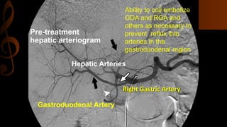 Hepatocellular carcinoma—role of interventional radiologist Dr ...