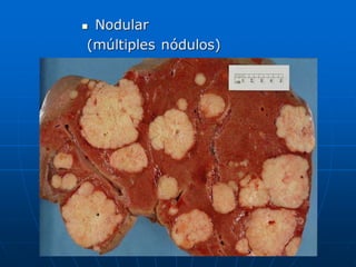 Hepatoma | PPTX