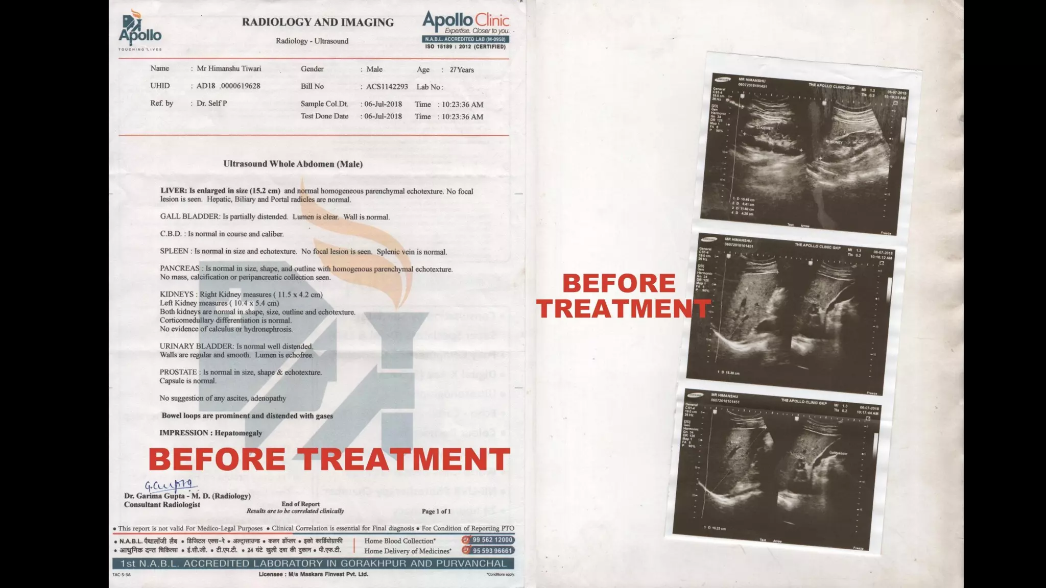 Hepatomegaly (15.2 cm, 152 mm liver enlargement) & Homoeopathy | PPT