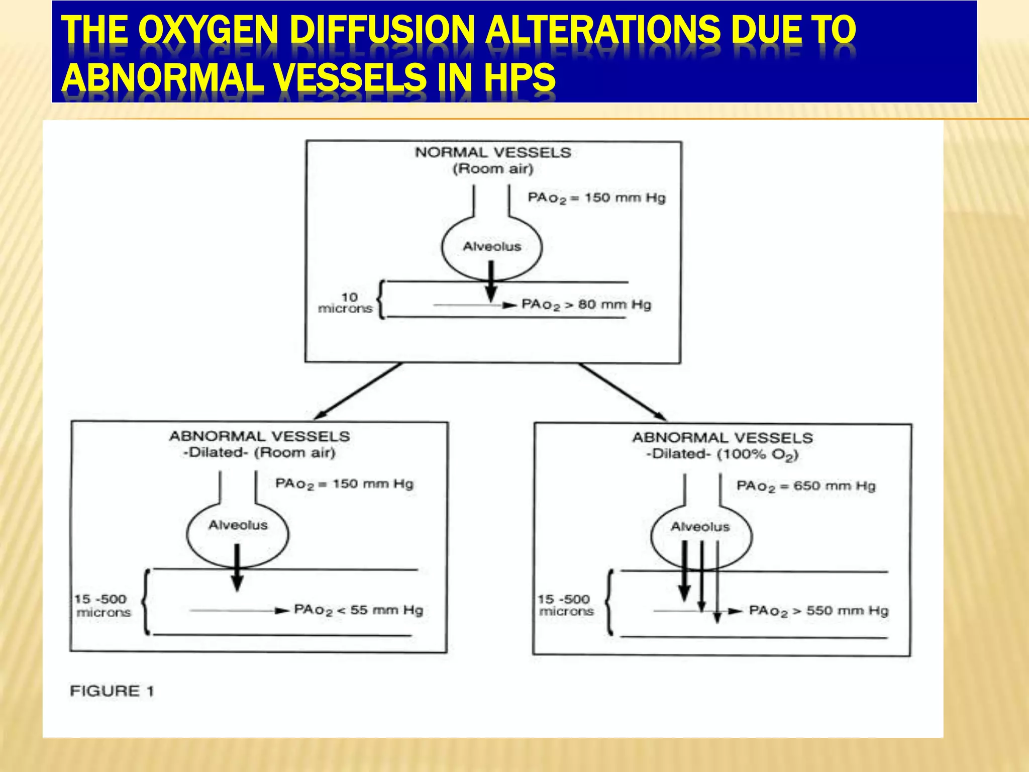 Hepatopulmonary syndrome | PPTX