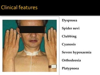Hepato pulmonary syndrome | PPT