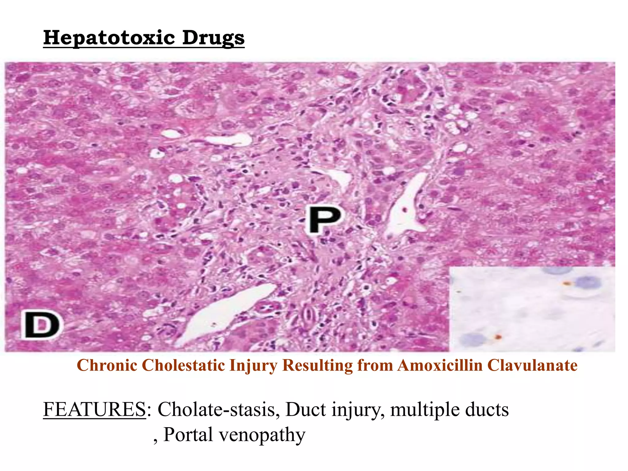 Hepatotoxic drugs | PPTX