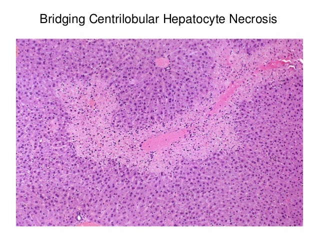 Hepatotoxicity