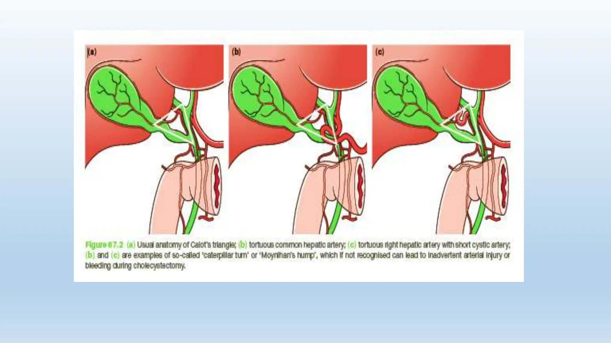 Hepato Biliary.pptx