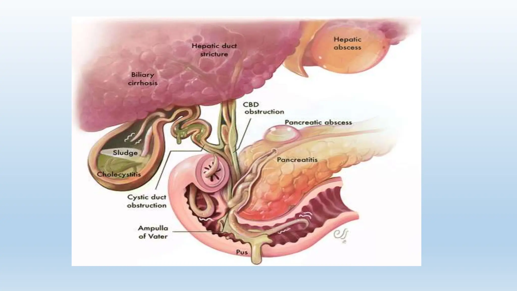 Hepato Biliary.pptx
