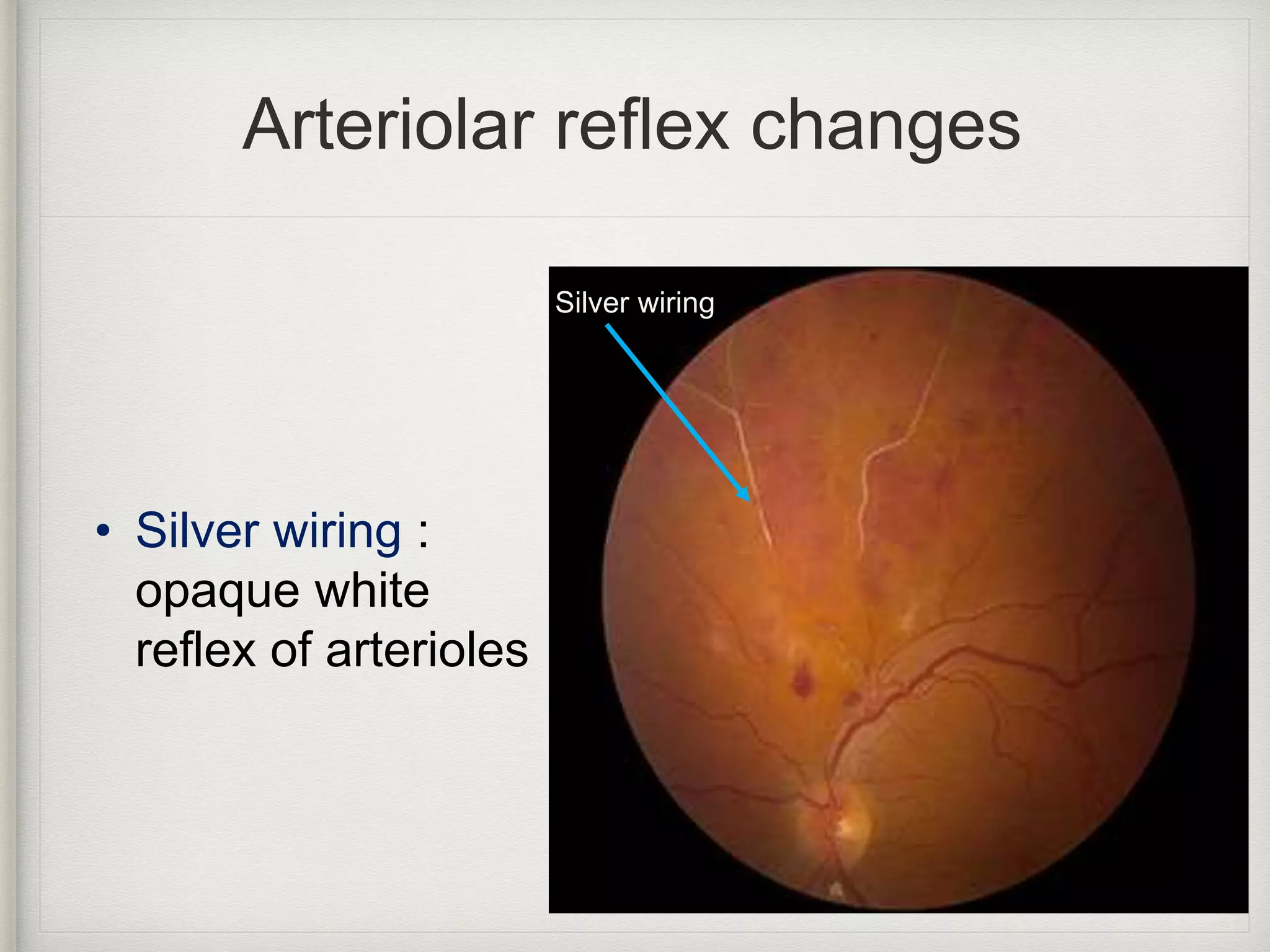 Hepertensive retinopathy , CENTRAL RETINAL ARTERY OCCLUSION ,CENTRAL ...