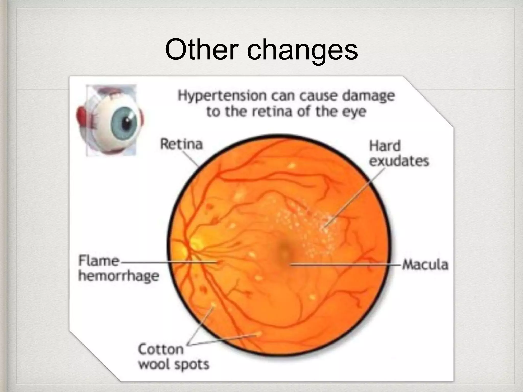 Hepertensive retinopathy , CENTRAL RETINAL ARTERY OCCLUSION ,CENTRAL ...