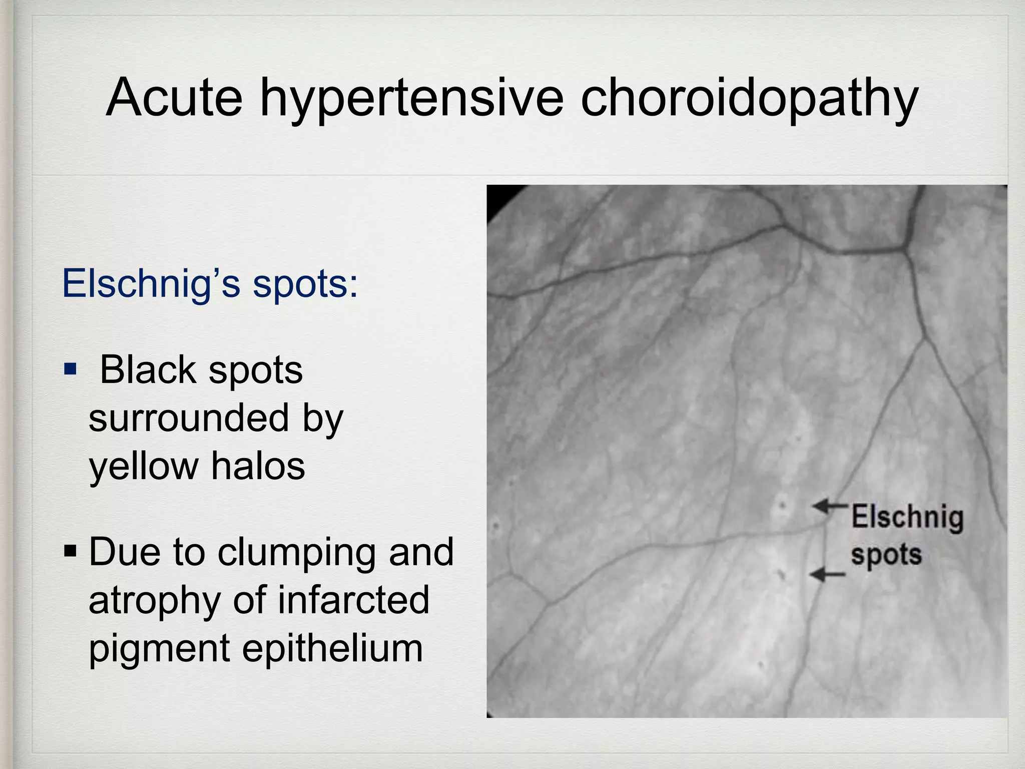 Hepertensive retinopathy , CENTRAL RETINAL ARTERY OCCLUSION ,CENTRAL ...