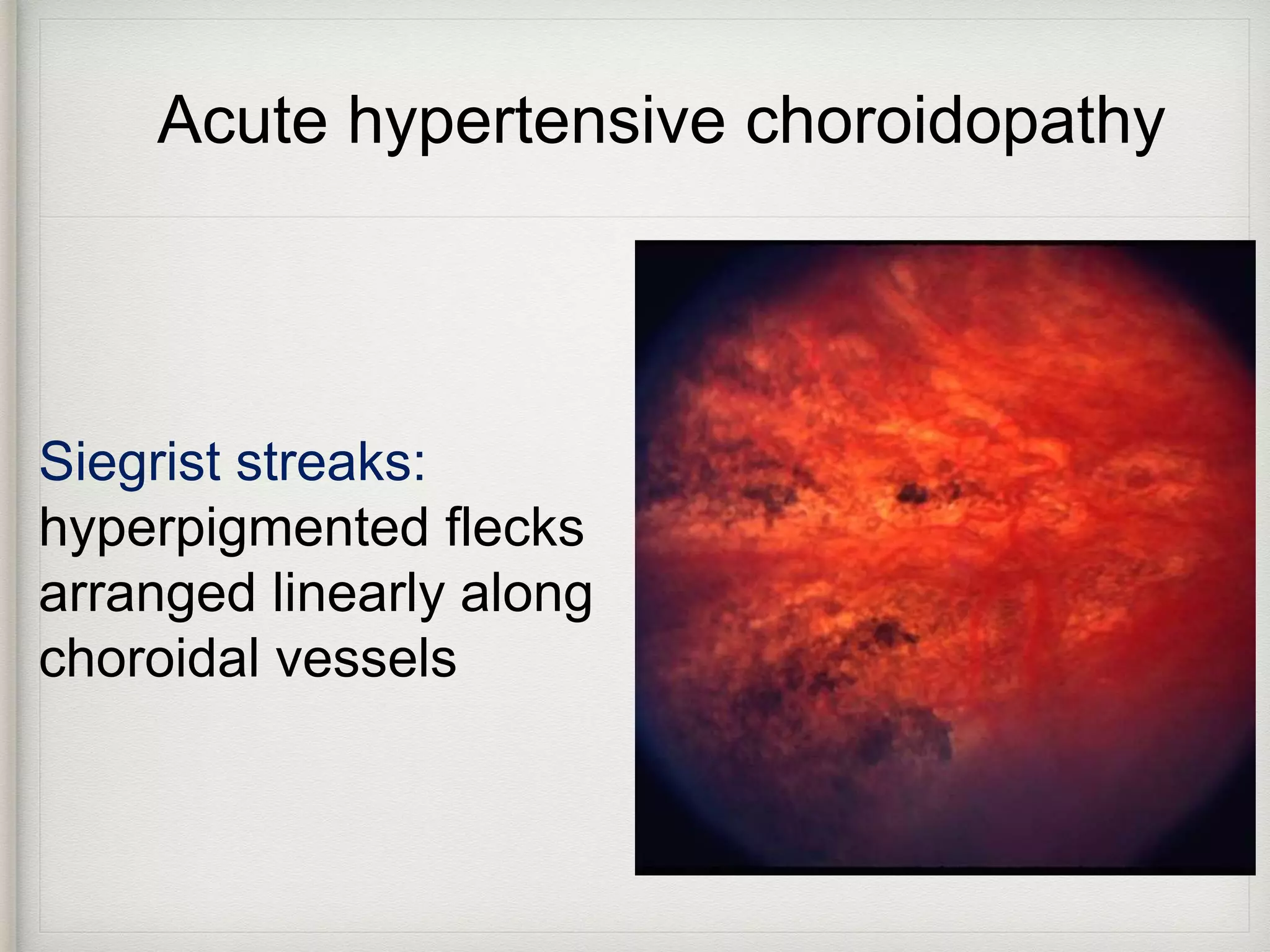 Hepertensive retinopathy , CENTRAL RETINAL ARTERY OCCLUSION ,CENTRAL ...