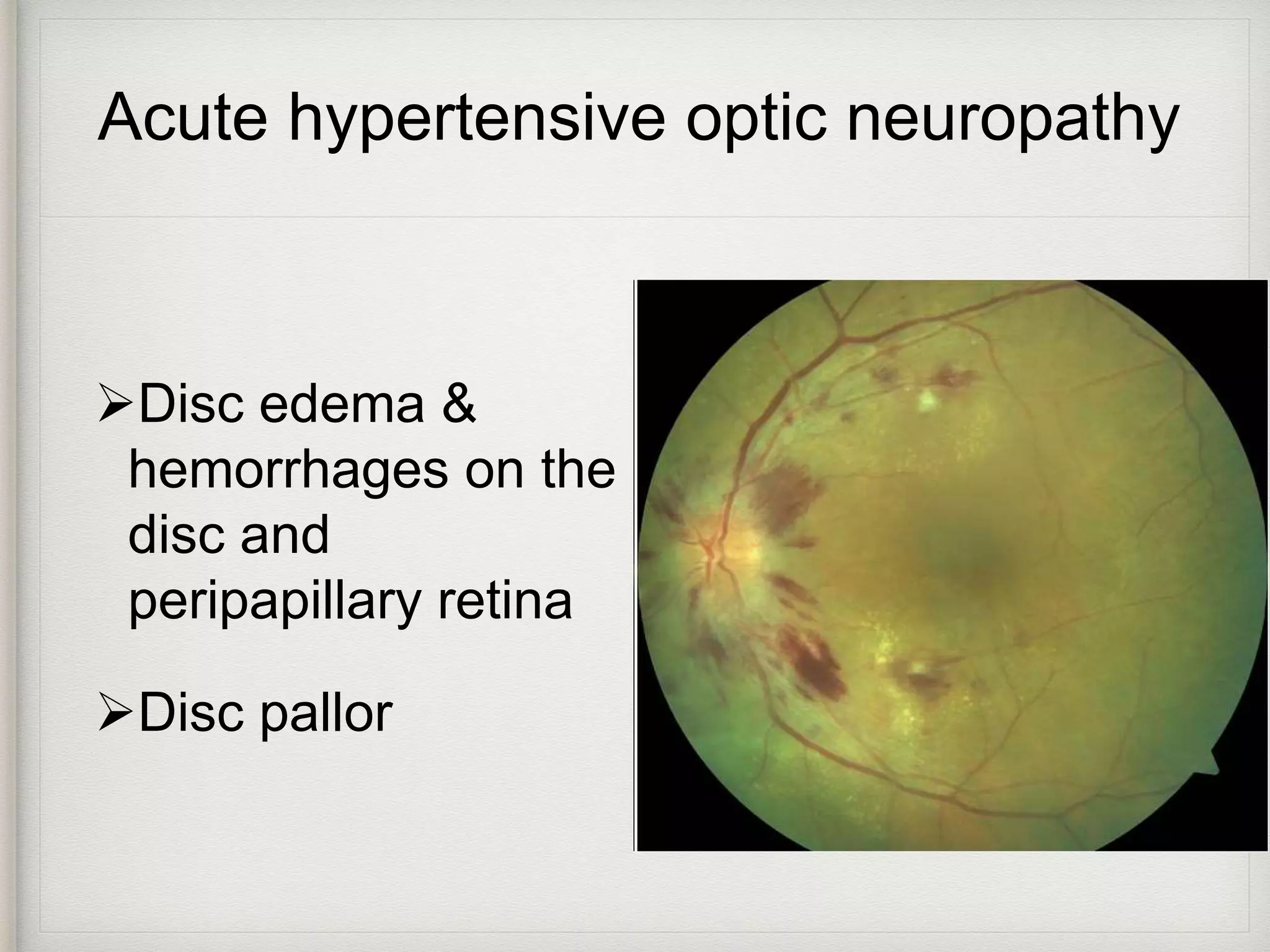 Hepertensive retinopathy , CENTRAL RETINAL ARTERY OCCLUSION ,CENTRAL ...
