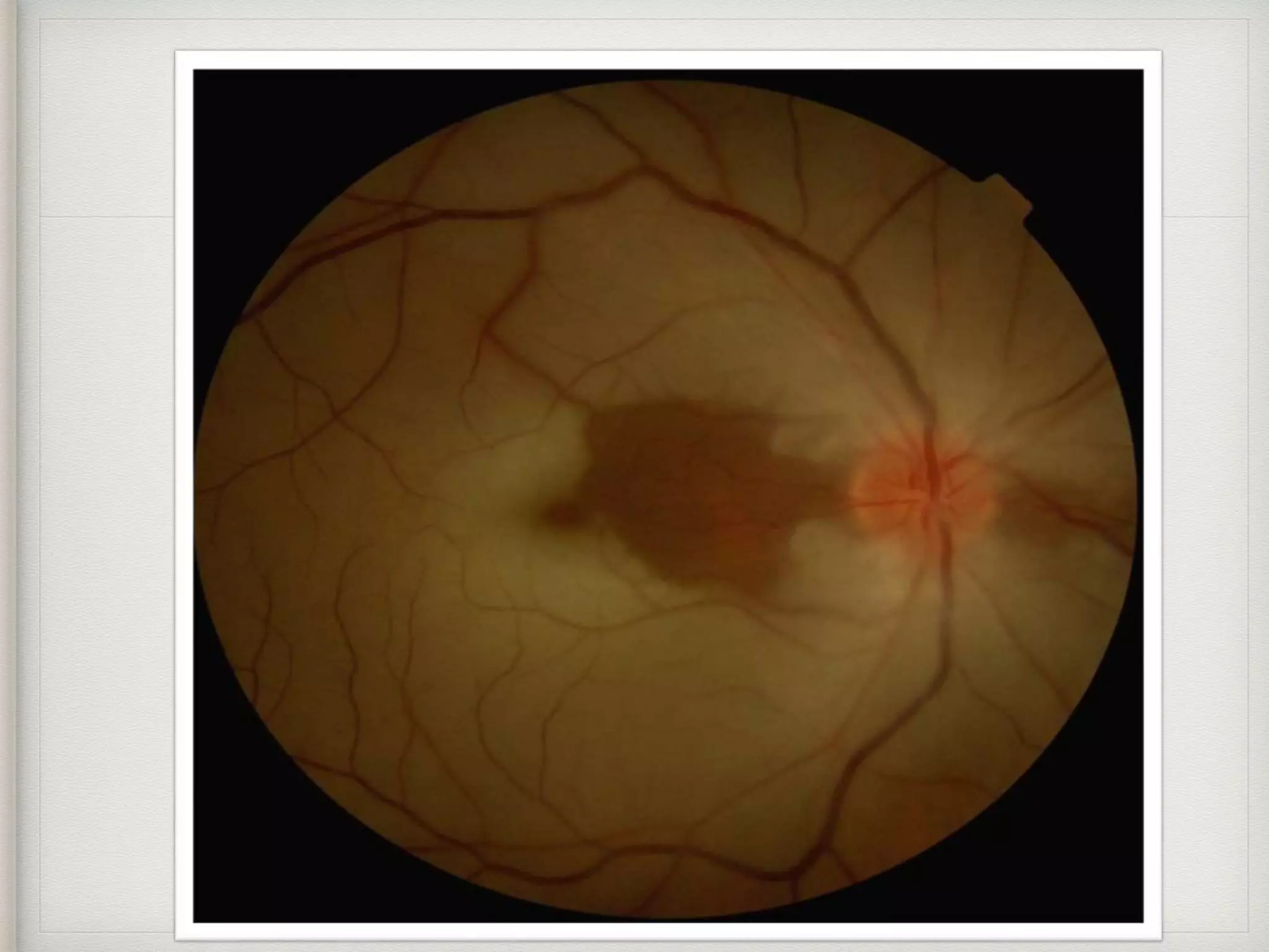 Hepertensive retinopathy , CENTRAL RETINAL ARTERY OCCLUSION ,CENTRAL ...