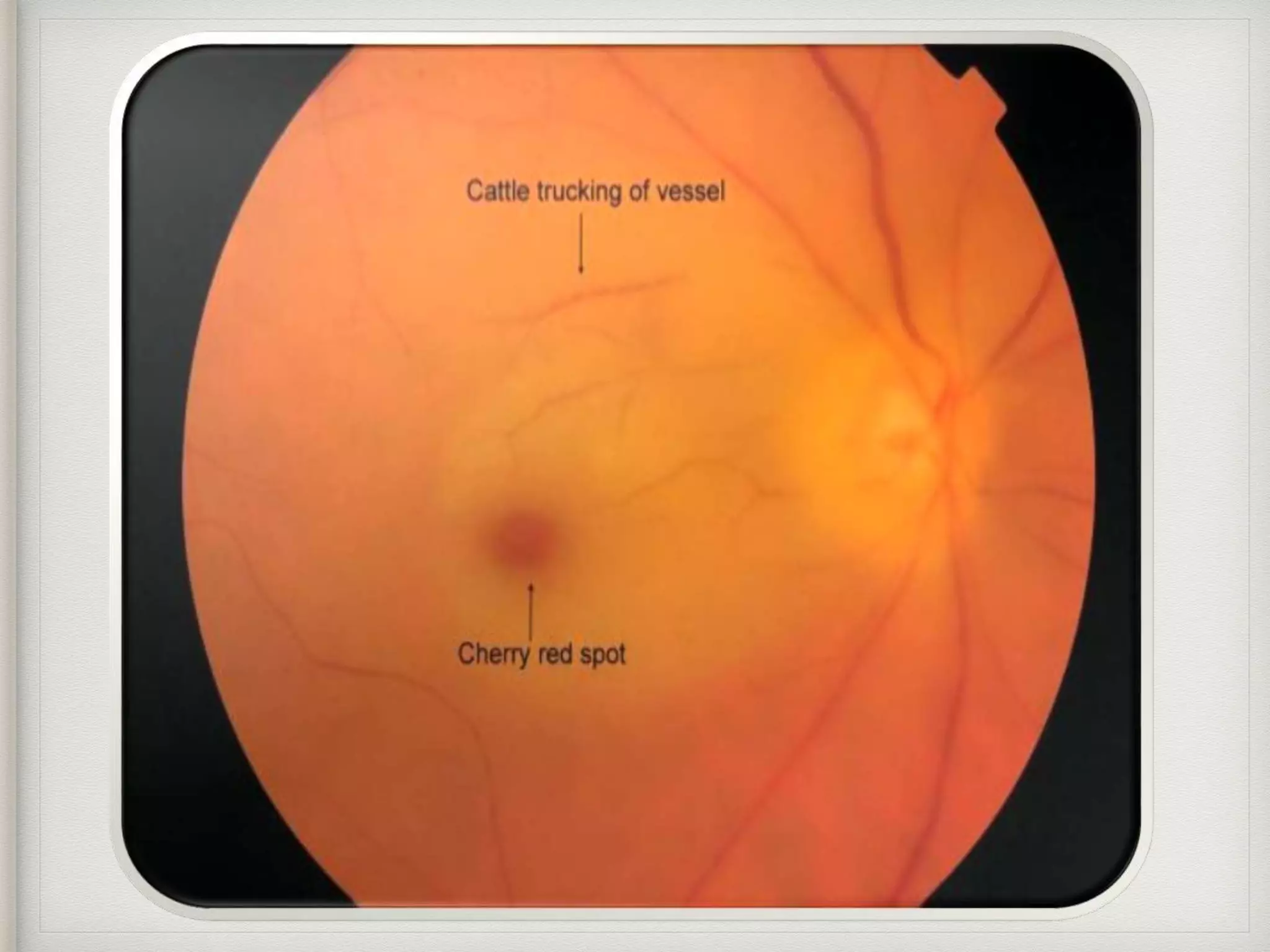 Hepertensive retinopathy , CENTRAL RETINAL ARTERY OCCLUSION ,CENTRAL ...