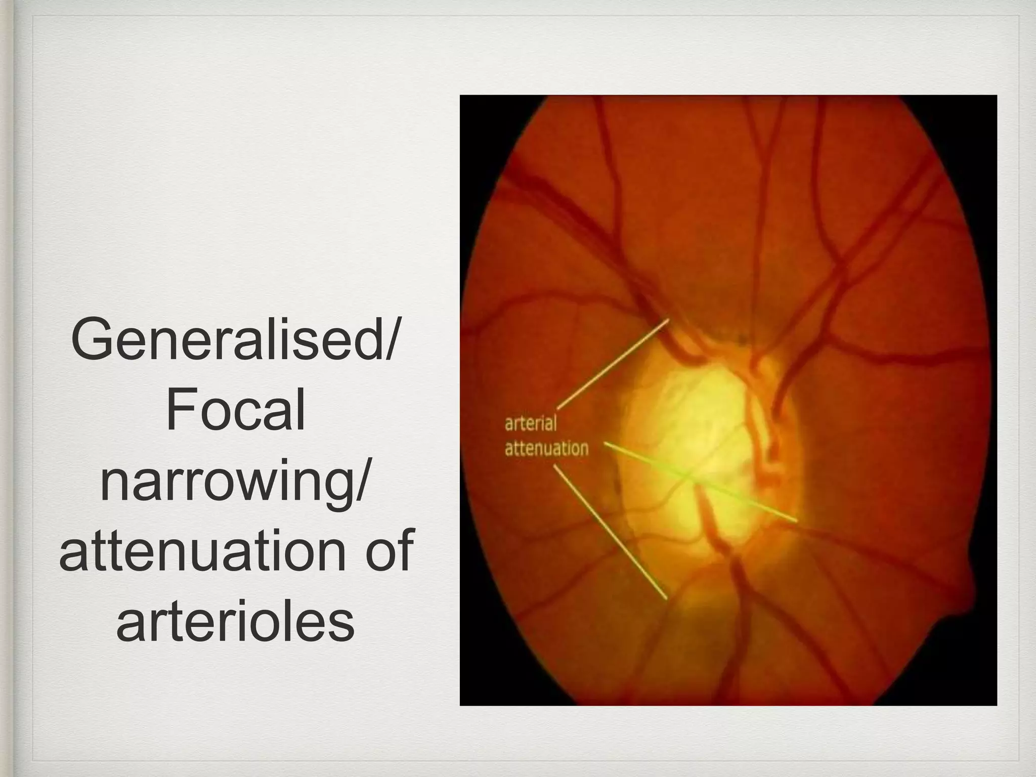 Hepertensive retinopathy , CENTRAL RETINAL ARTERY OCCLUSION ,CENTRAL ...