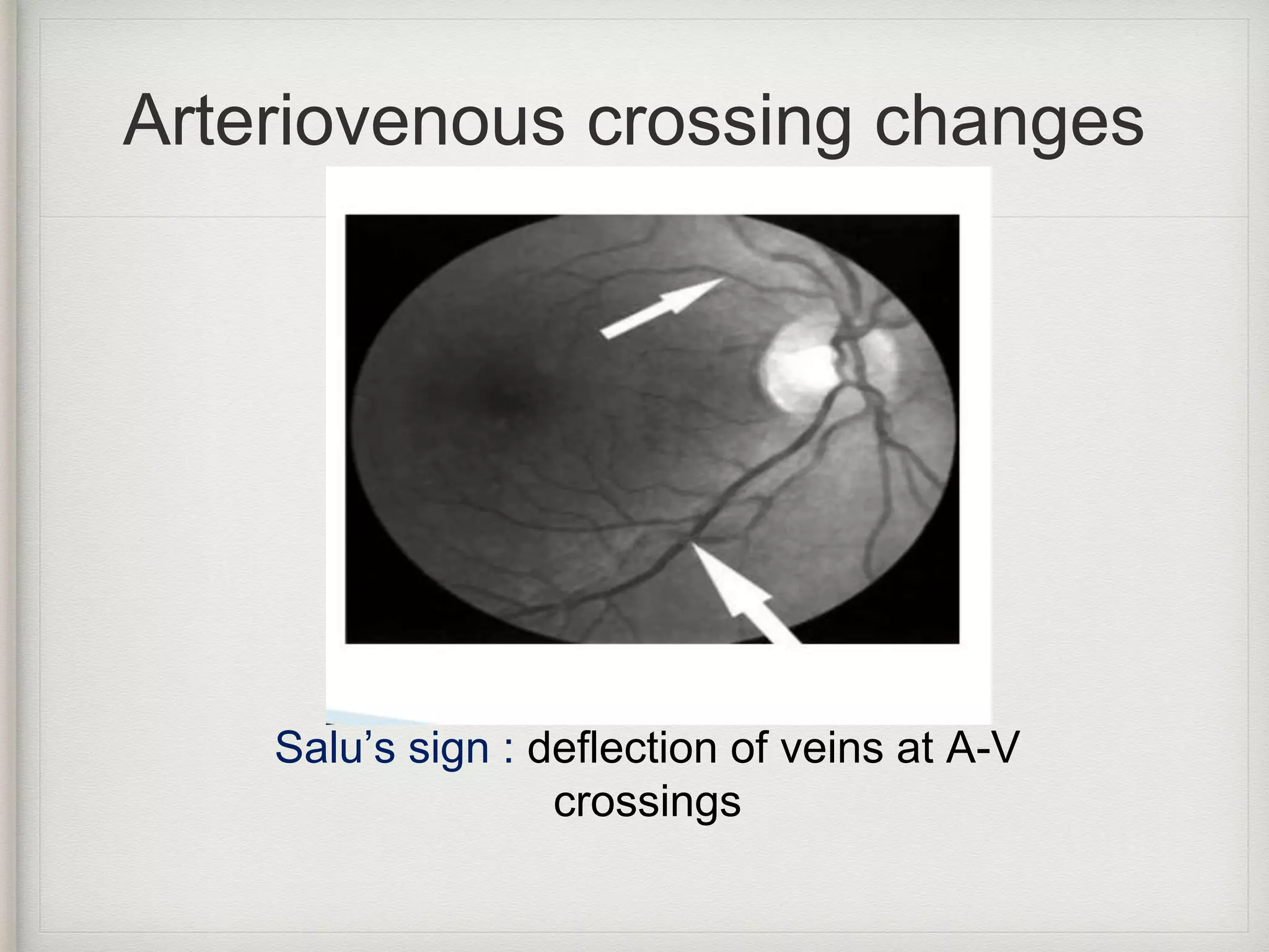 Hepertensive retinopathy , CENTRAL RETINAL ARTERY OCCLUSION ,CENTRAL ...