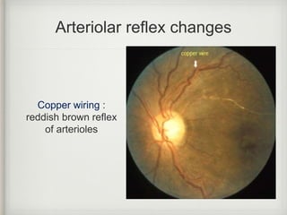 Hepertensive retinopathy , CENTRAL RETINAL ARTERY OCCLUSION ,CENTRAL ...