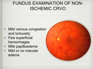 Hepertensive retinopathy , CENTRAL RETINAL ARTERY OCCLUSION ,CENTRAL ...