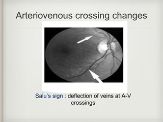 Hepertensive retinopathy , CENTRAL RETINAL ARTERY OCCLUSION ,CENTRAL ...