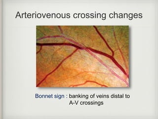 Hepertensive retinopathy , CENTRAL RETINAL ARTERY OCCLUSION ,CENTRAL ...