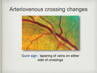 Hepertensive retinopathy , CENTRAL RETINAL ARTERY OCCLUSION ,CENTRAL ...