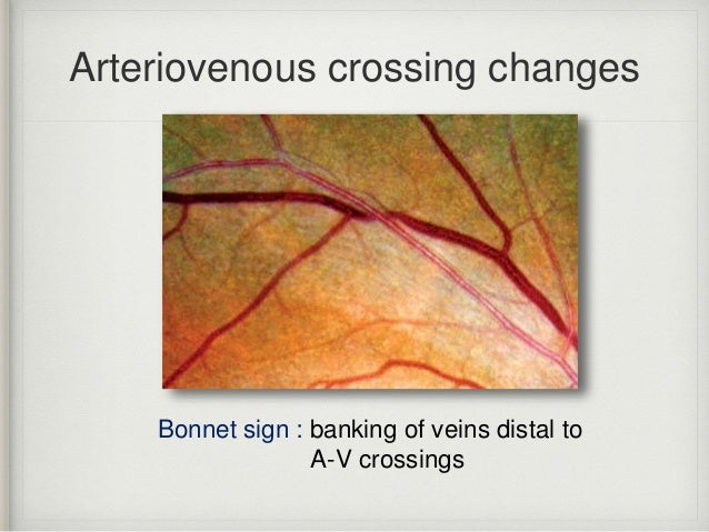 Hepertensive retinopathy , CENTRAL RETINAL ARTERY OCCLUSION ,CENTRAL