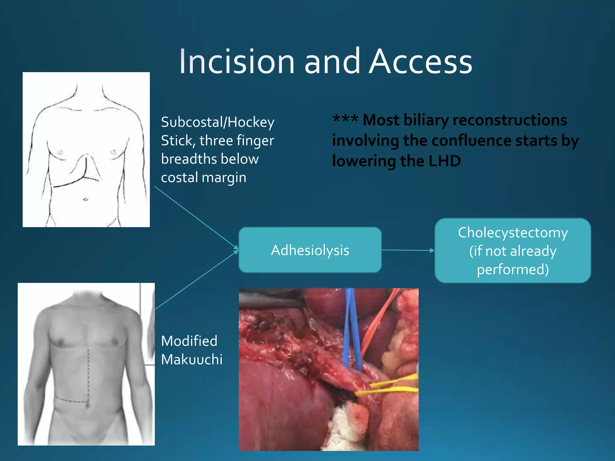 Biliary Anatomy and Reconstruction of the Biliary Tract | PPTX