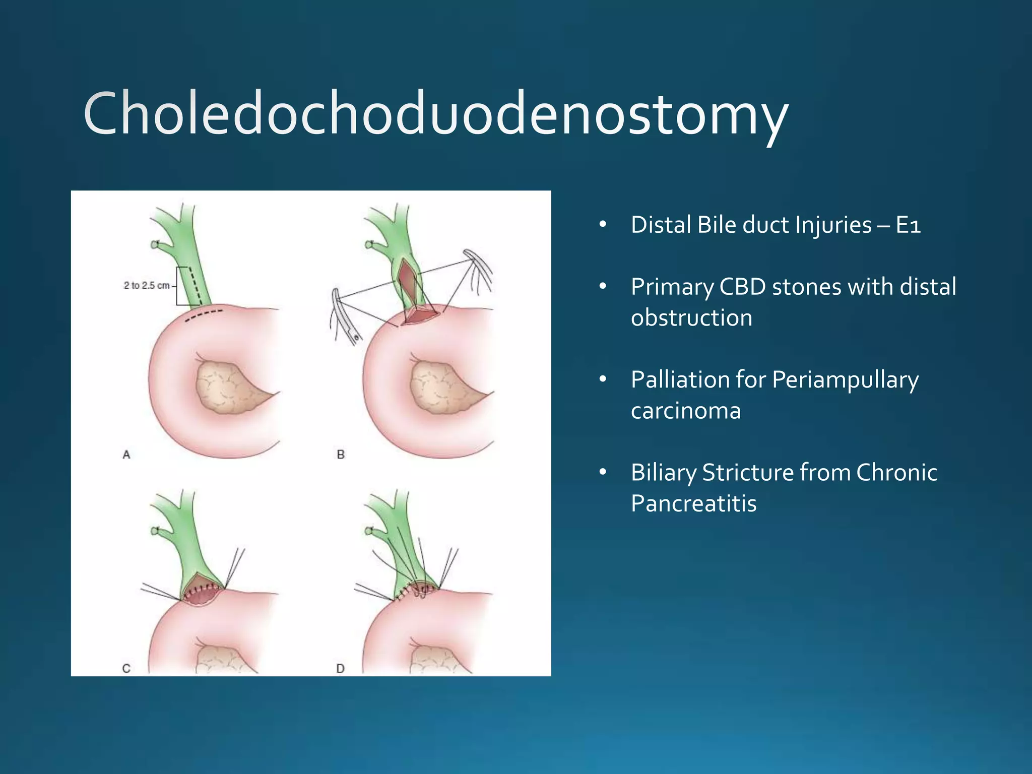 Biliary Anatomy and Reconstruction of the Biliary Tract | PPTX