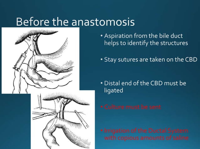Biliary Anatomy and Reconstruction of the Biliary Tract | PPT