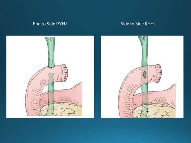 Biliary Anatomy and Reconstruction of the Biliary Tract | PPT