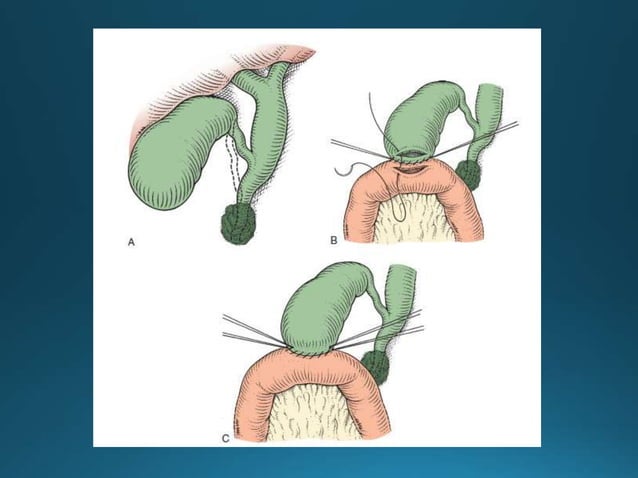 Biliary Anatomy and Reconstruction of the Biliary Tract | PPT