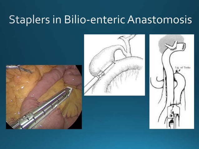 Biliary Anatomy and Reconstruction of the Biliary Tract | PPT