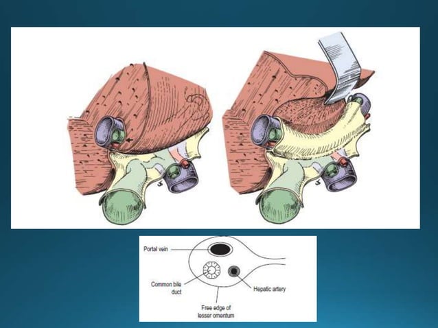 Biliary Anatomy and Reconstruction of the Biliary Tract | PPT