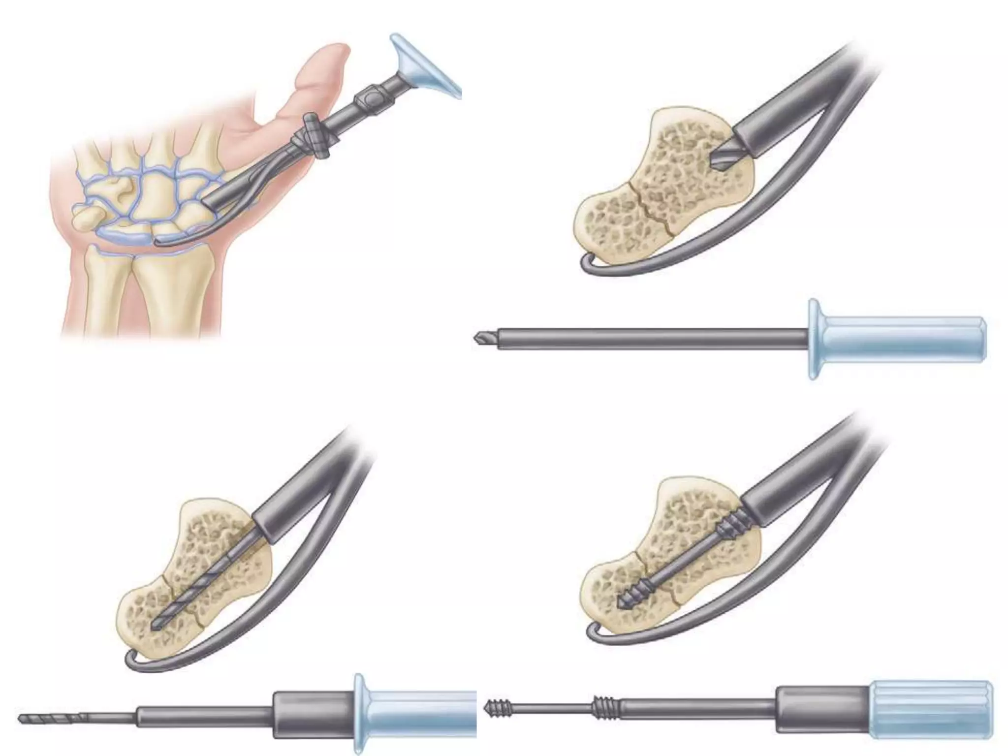 Herbert screw fixation and bone graft in nonunited scaphoid | PPTX