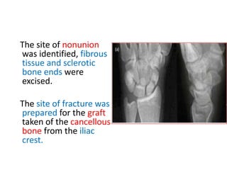 Herbert screw fixation and bone graft in nonunited scaphoid | PPTX