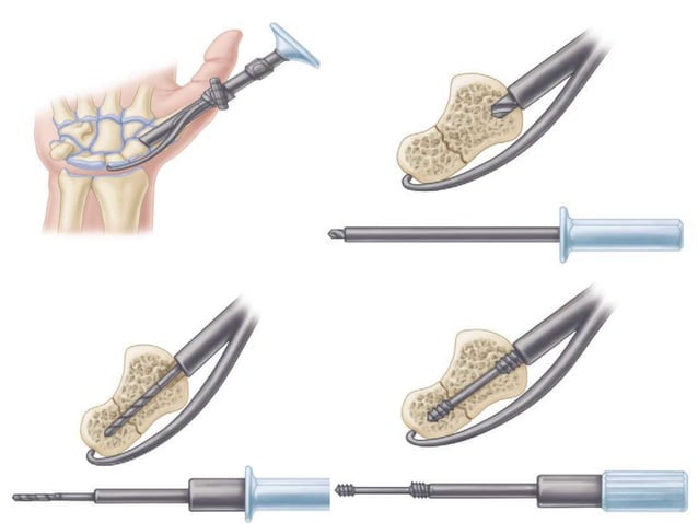 Herbert screw fixation and bone graft in nonunited scaphoid | PPTX