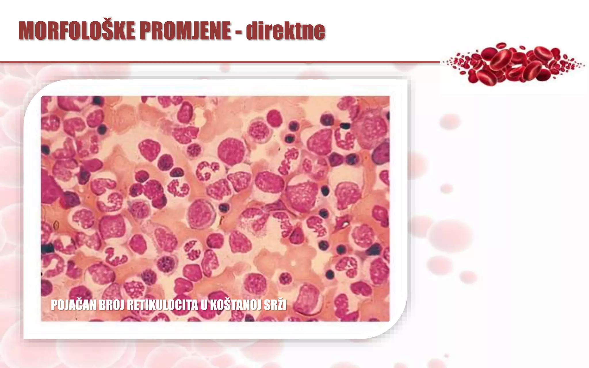 Hereditarna sferocitoza | PPTX