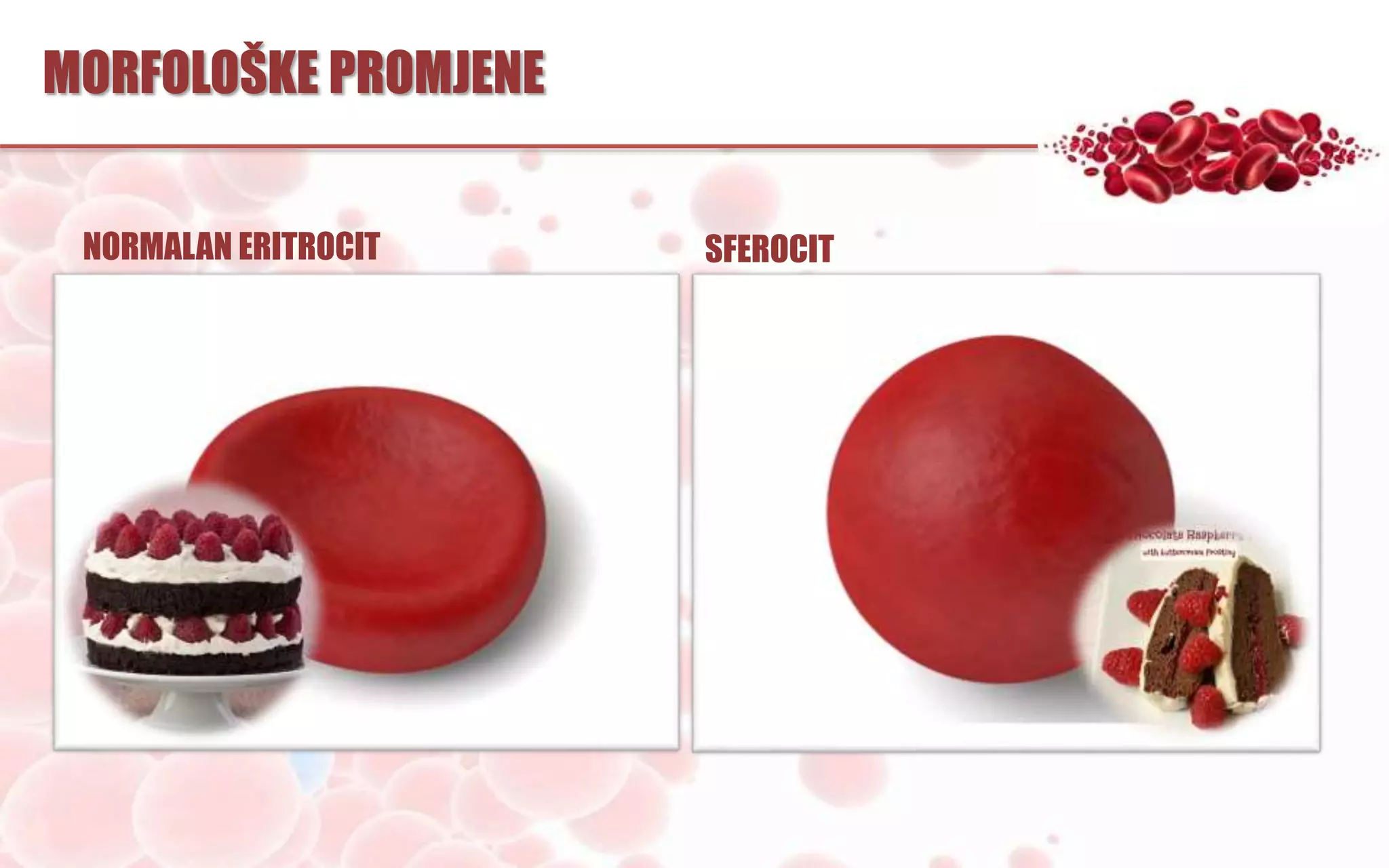 Hereditarna sferocitoza | PPTX